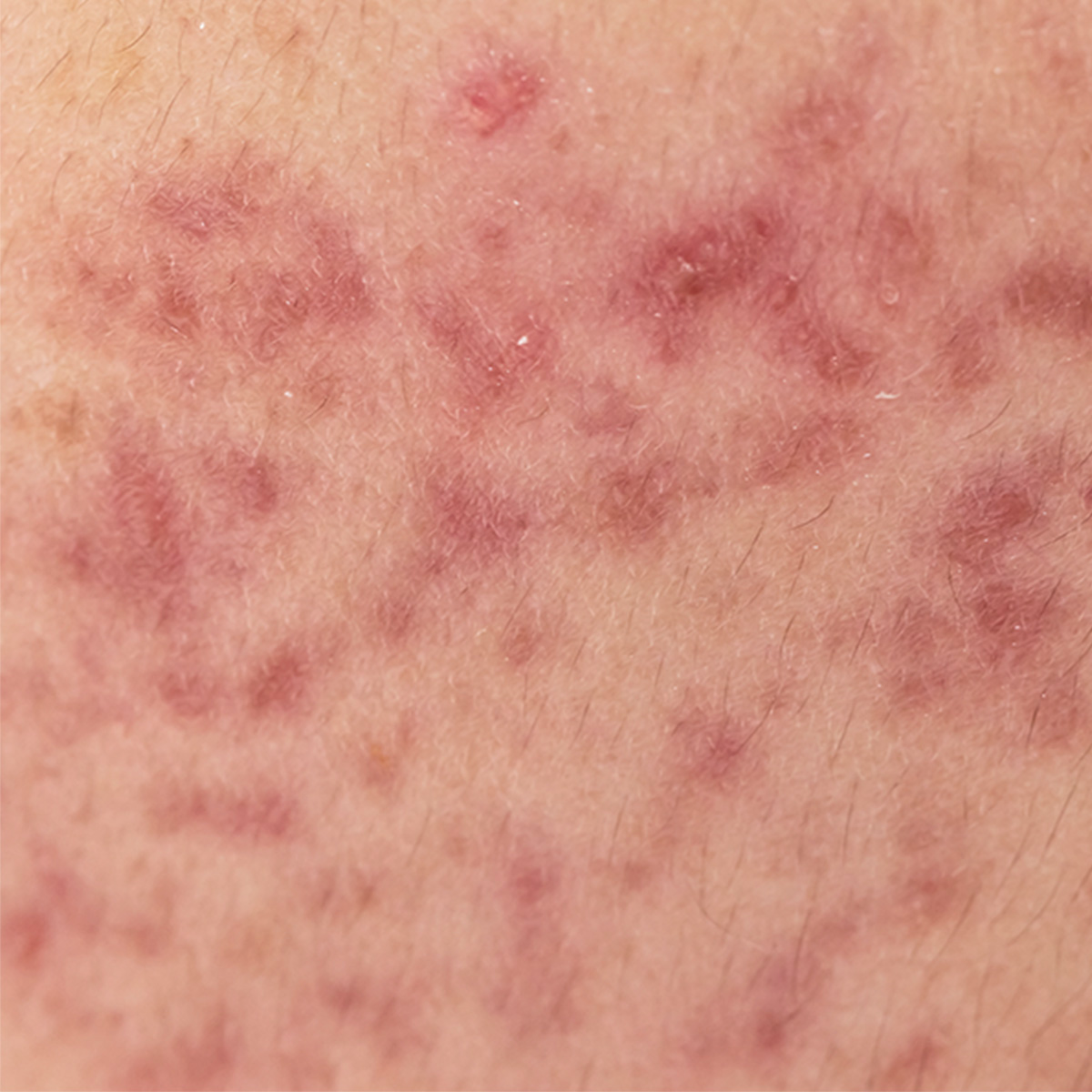 Treating the factors and Influences of Acne - pHformula