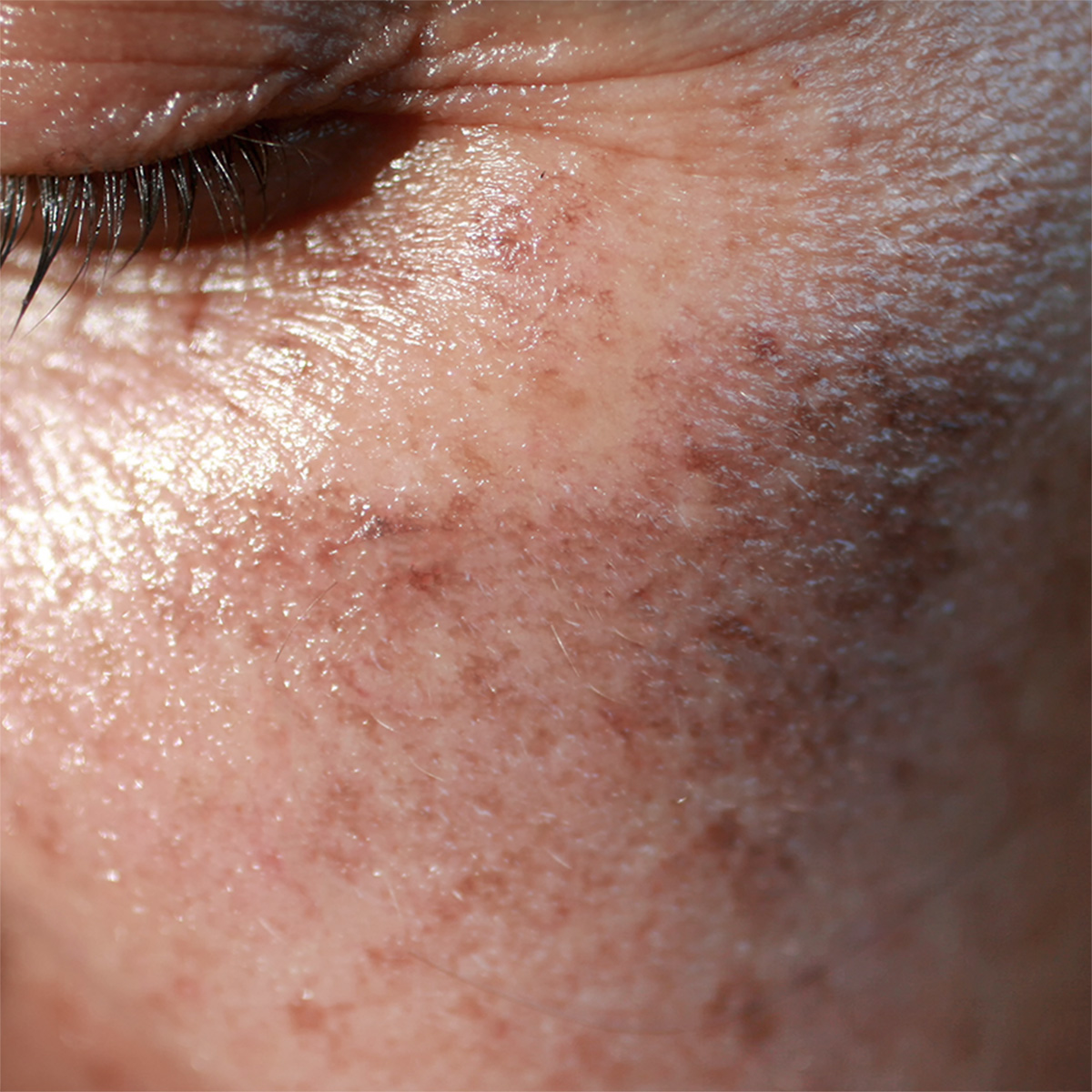 What does the sun do to your skin? - pHformula