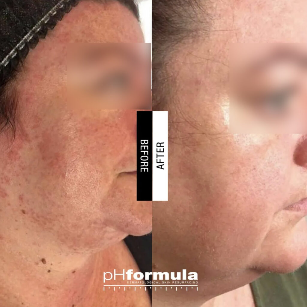 chronic redness resurfacing treatments - pHformula