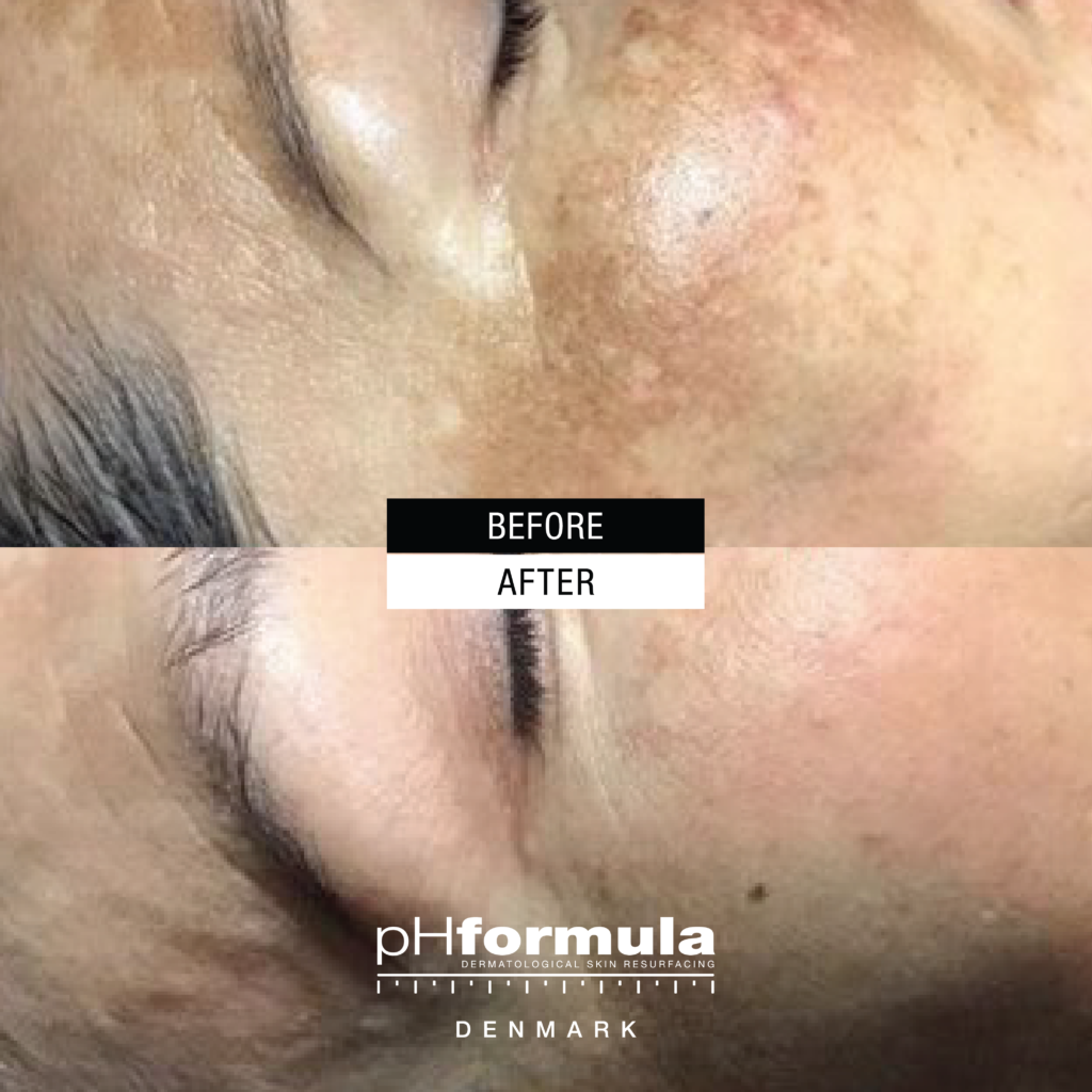 hyperpigmentation treatments - pHformula